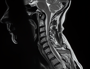 IRM Colonne cervicale - IRM des Sources