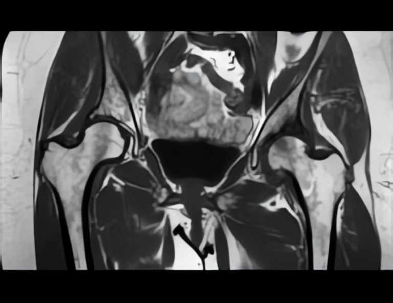 IRM du bassin et des hanches - IRM des Sources