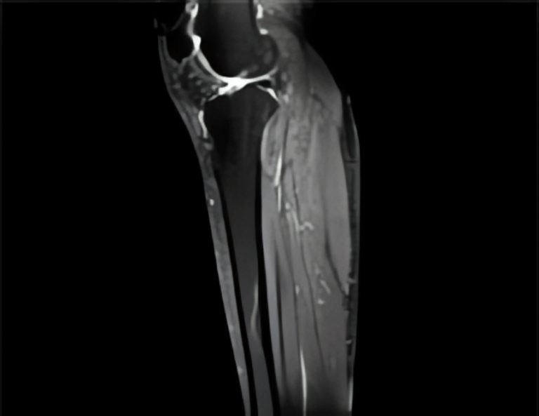 IRM de la jambe - IRM des Sources