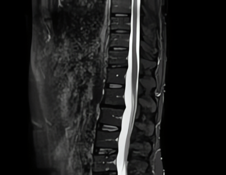 IRM Colonne vertébrale et médullaire - IRM des Sources
