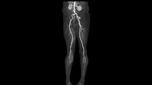 IRM angio des membres inférieurs - IRM des Sources